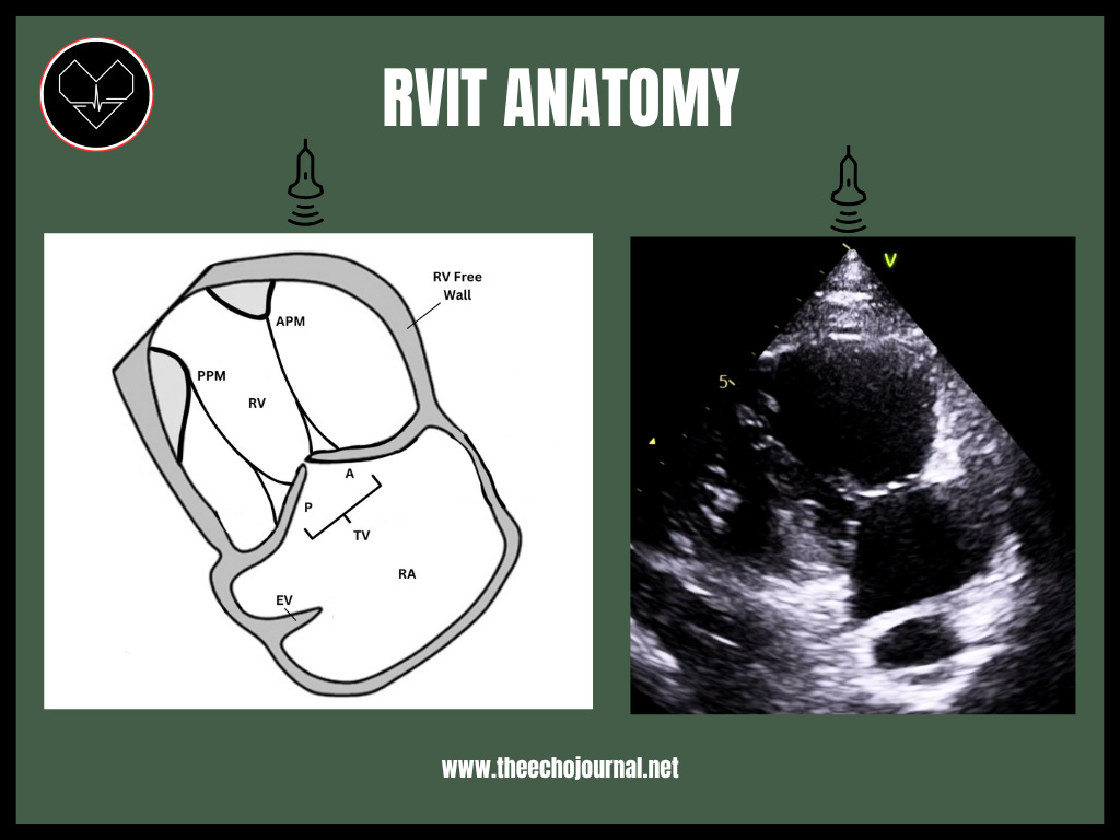 Parasternal Long Axis: What to Acquire and How to Measure