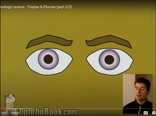 Phoria vs. Tropia: Unpacking Ocular Misalignments and the Crucial Skew ...