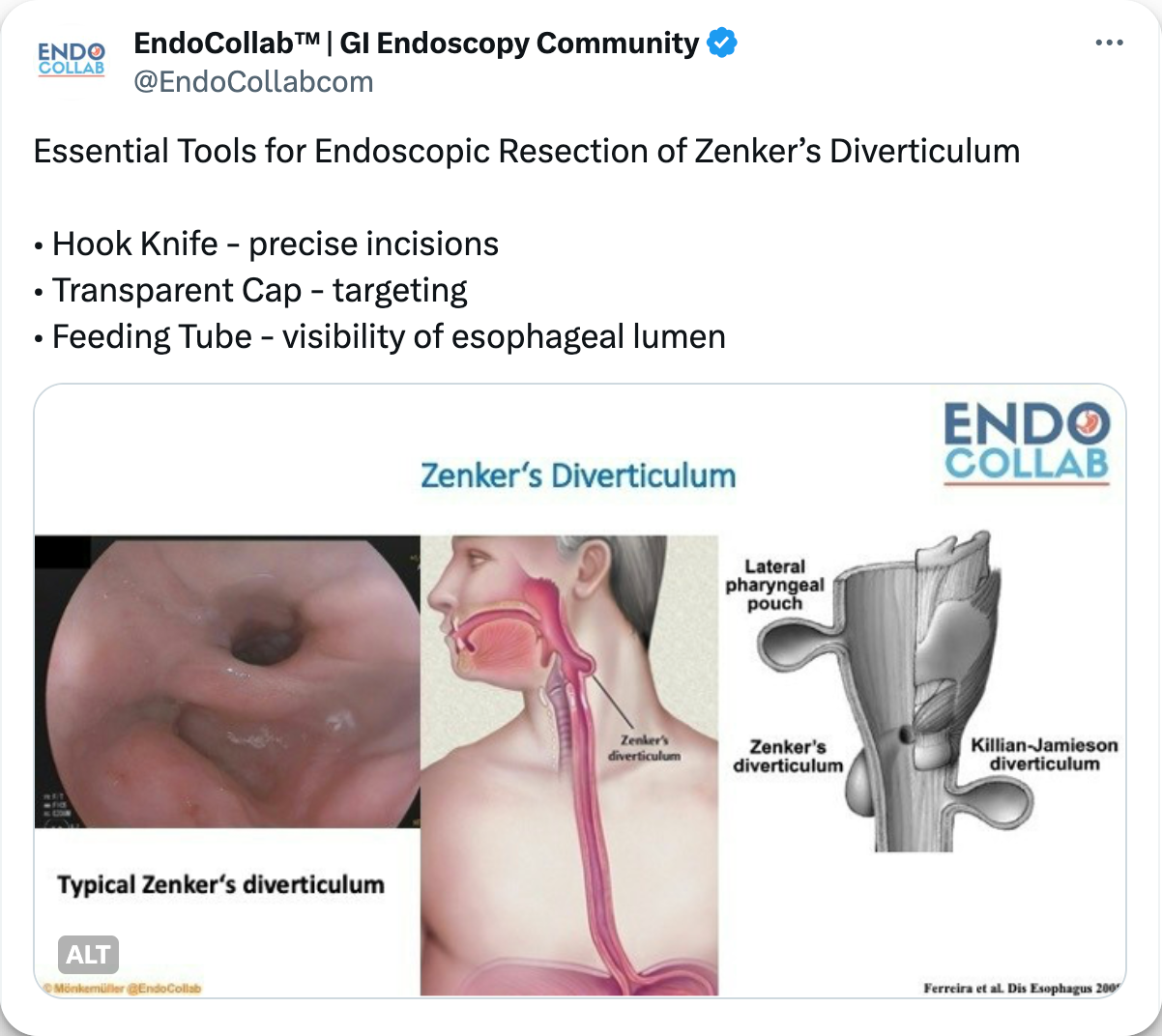 killian triangle diverticulum