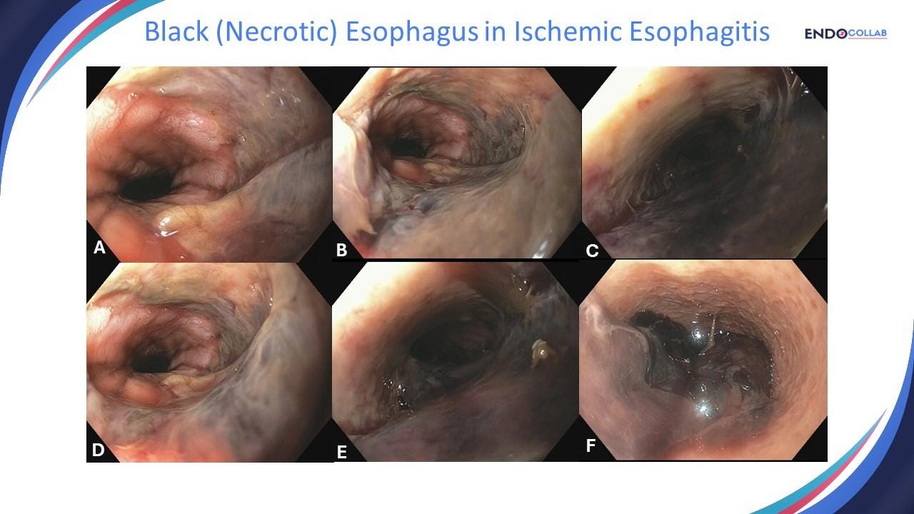 Practical Review: Gurvits Syndrome - EndoCollab