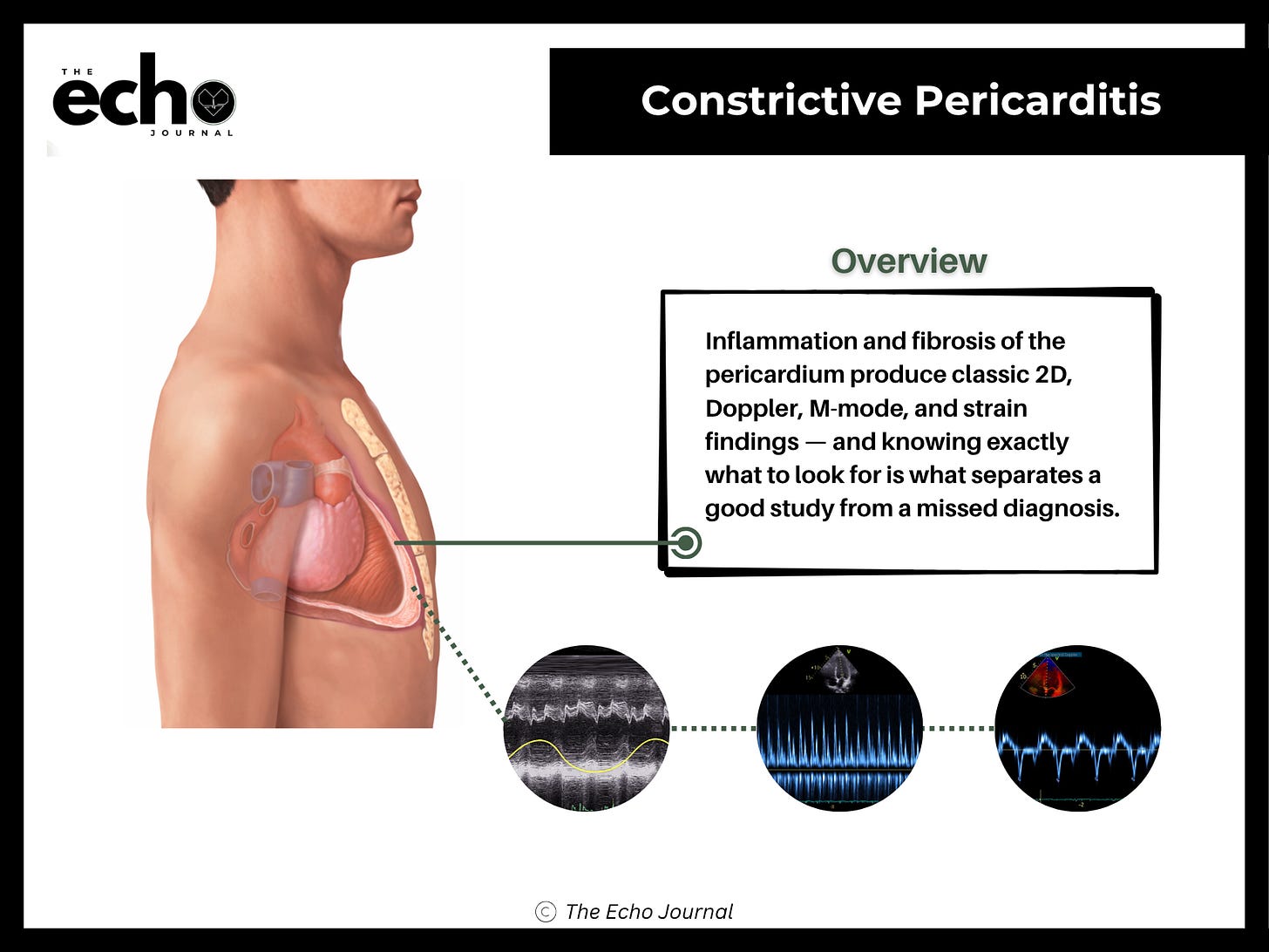 Constrictive Pericarditis: The Echo Findings You Can't Afford to Miss