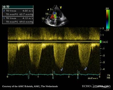 TEER After MI: Not All Mitral Regurg Is Created Equal