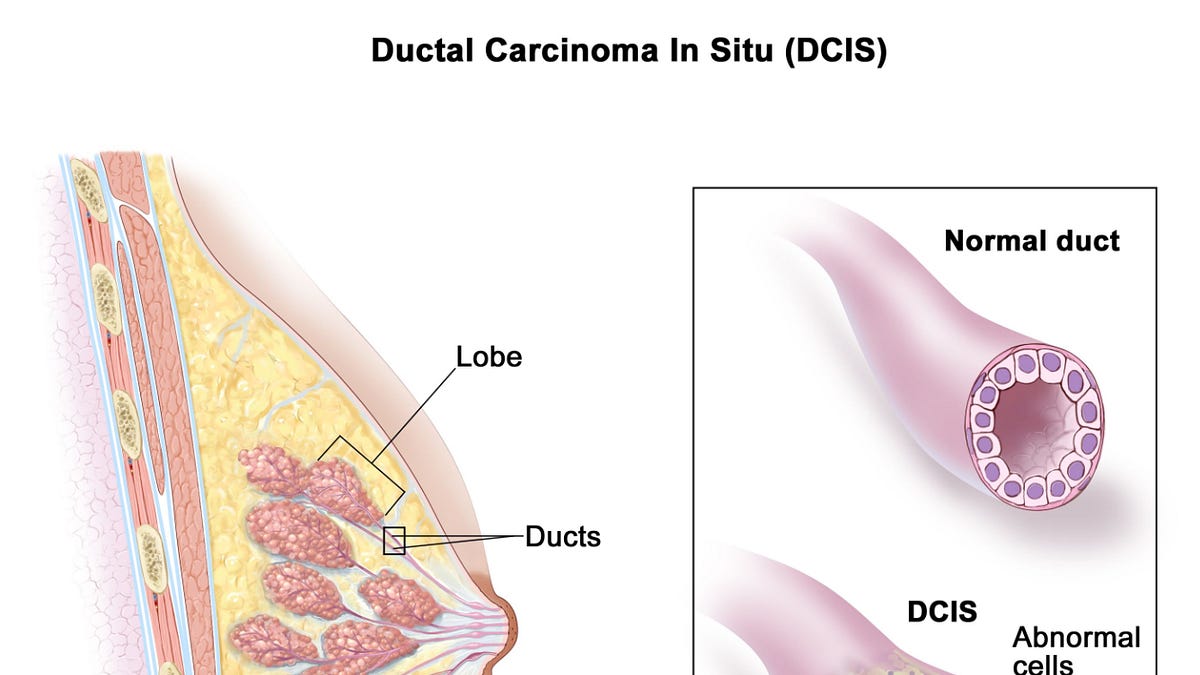 Ductal Carcinoma in Situ (DCIS): Understanding Stage 0 Breast Cancer