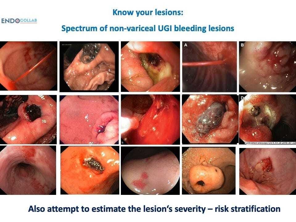 Treating Upper Gastrointestinal Bleeding: An Update on Endoscopic ...
