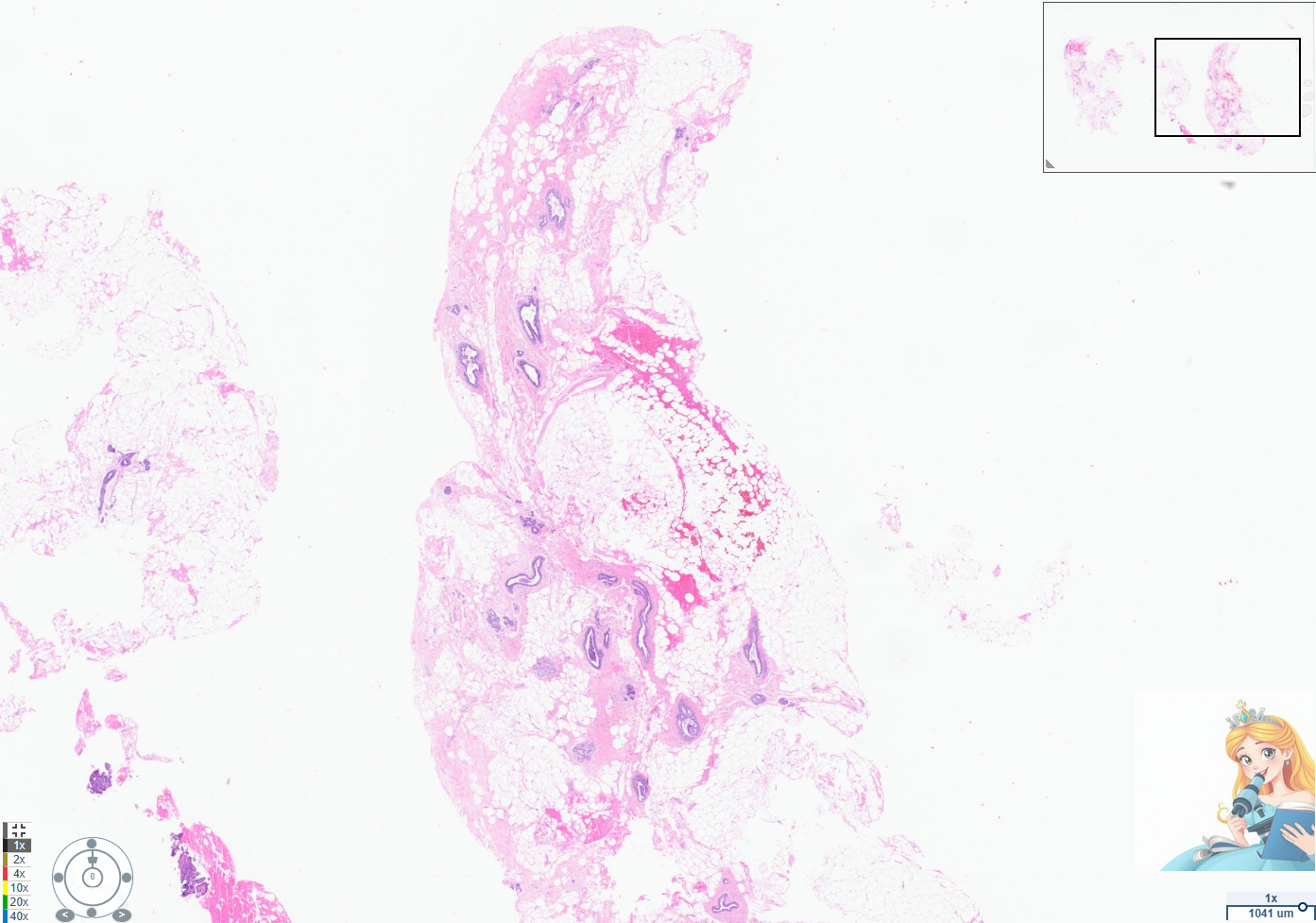 Fibrocystic Change with Stromal Fibrosis