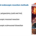 Master Post-Polypectomy Bleeding: An Endoscopist's Guide to Prevention ...
