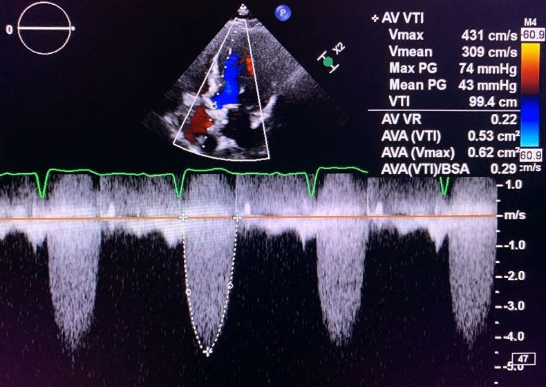 When Waves Collide: A Guide to Sorting Out Doppler Drama
