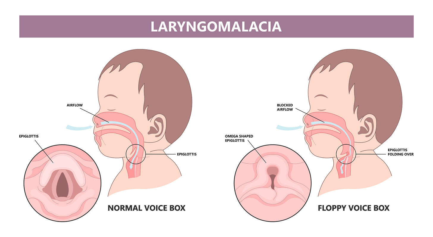 epiglottis in children