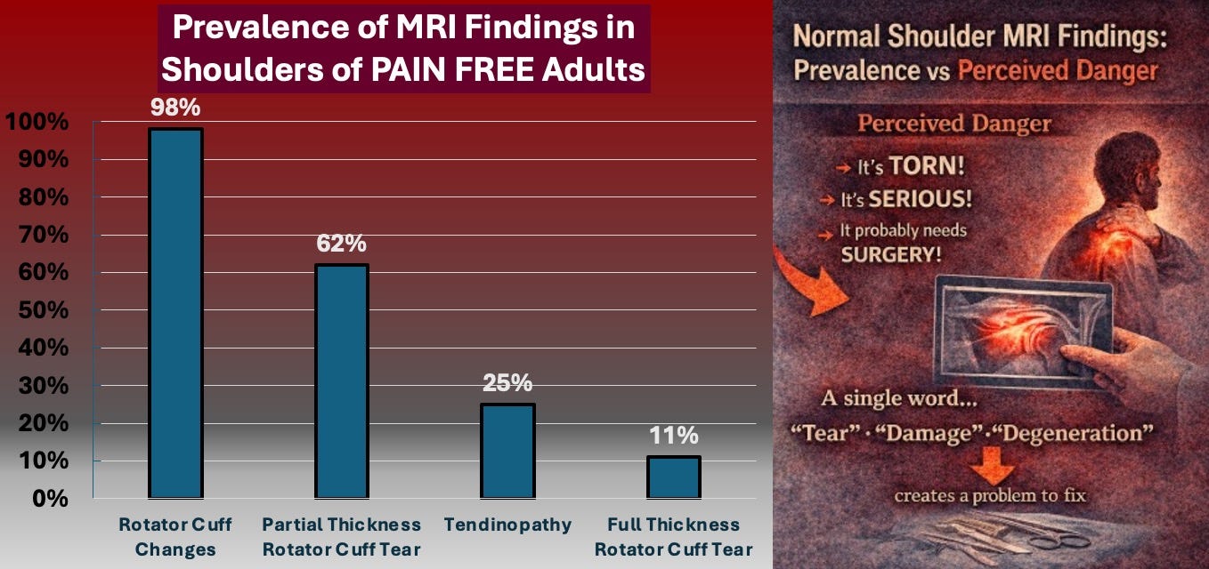 For 99% of human history, rotator cuff tears existed. We just hadn’t ...