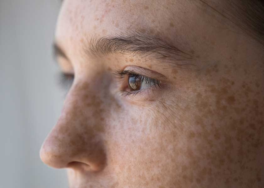 freckles all year round
