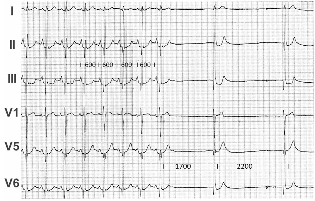 ECG Teaching Cases: She's Shaking; It Must be a Seizure! - האיגוד ...