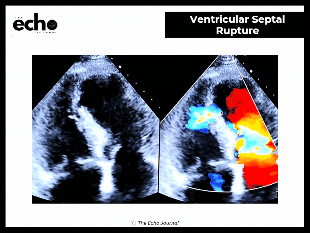 Ventricular Septal Rupture: The Echo That Changes Everything