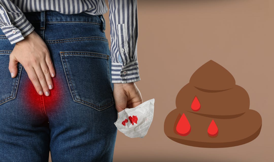Sangue nas fezes: 9 principais causas (e o que fazer)