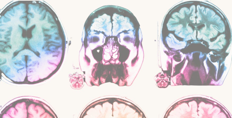 Neuroinflammation - by Cortney Gensemer, PhD