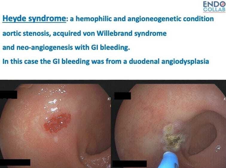 Angiodysplasias of the “Cecum” and Aortic Stenosis: Heyde's Syndrome