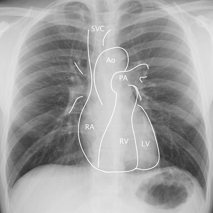 Chest anatomy - radiographs and CT - RadNotes