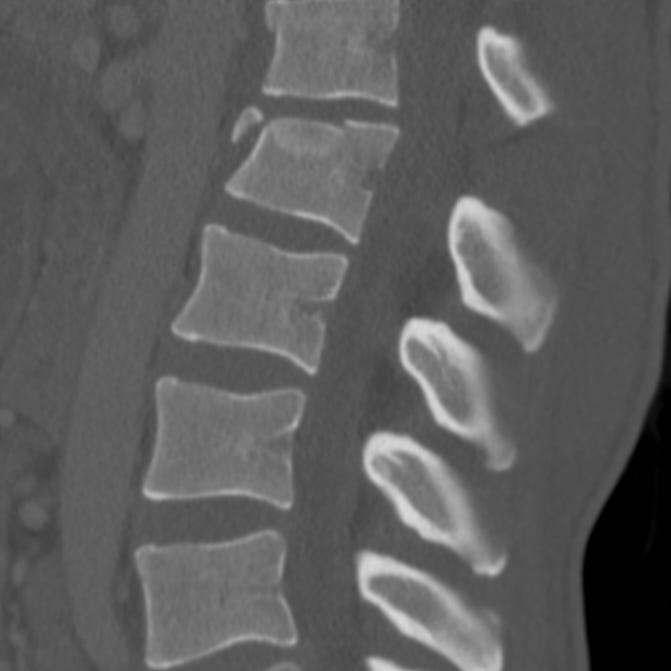 Spinal distraction injuries and dislocation