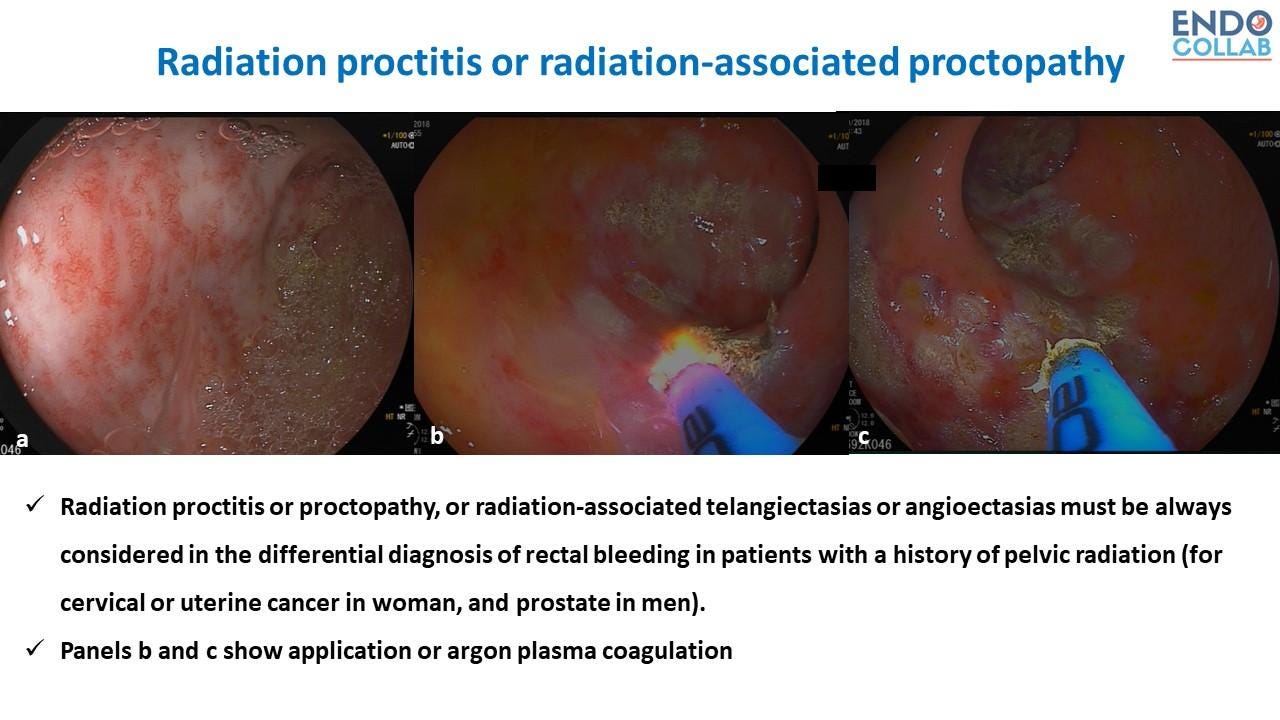 Six Top Tips to Use Argon Plasma Coagulation When Treating ...
