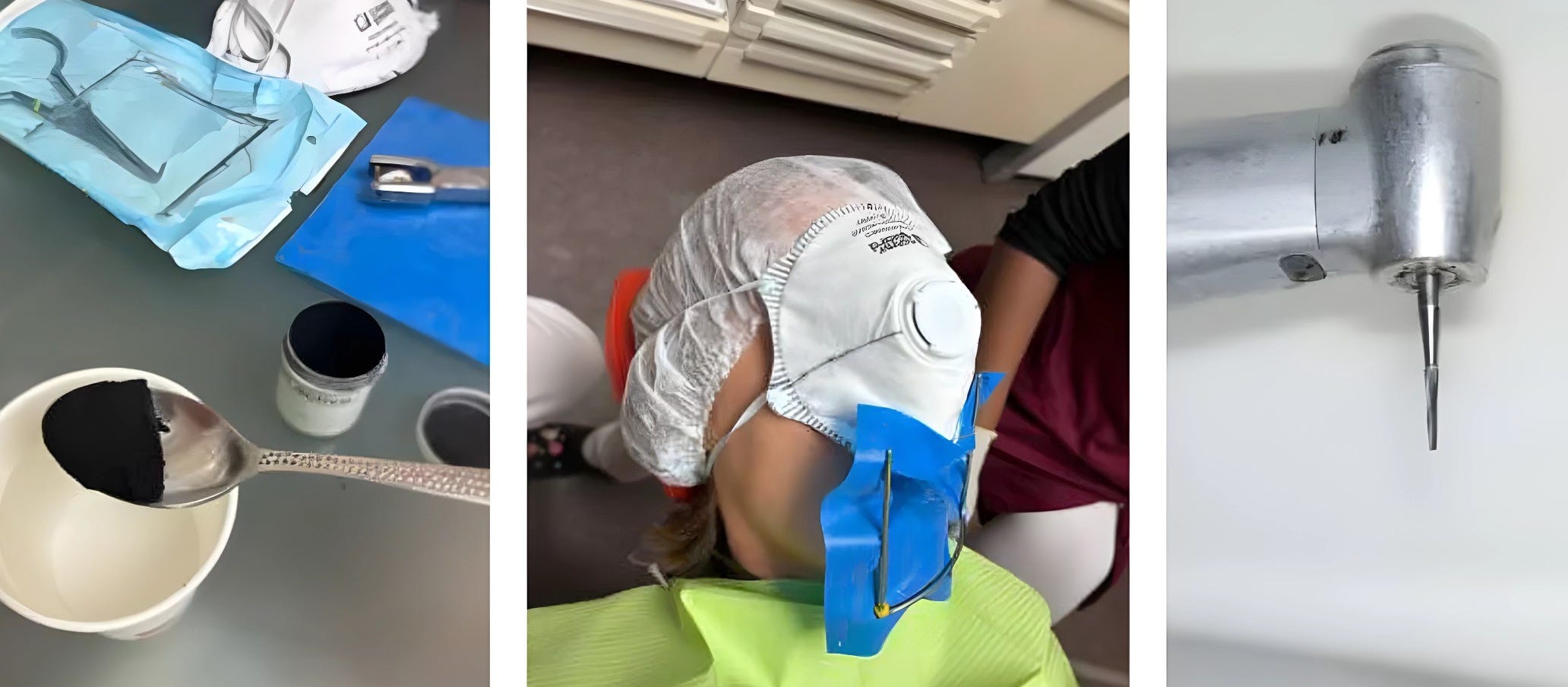 MasterPeace and Safe Dental Amalgam Removal