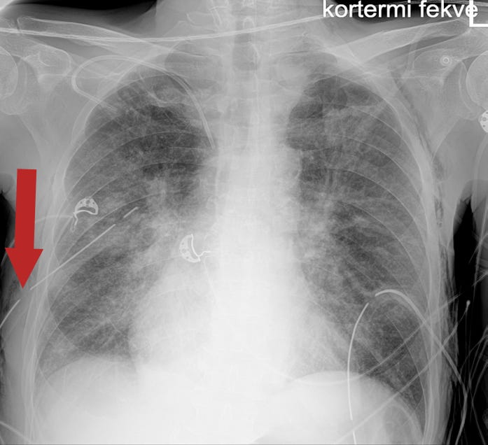 Chest Tubes & Pigtails: 5 Must-Know Tips for ICU Rotation - Maher ...