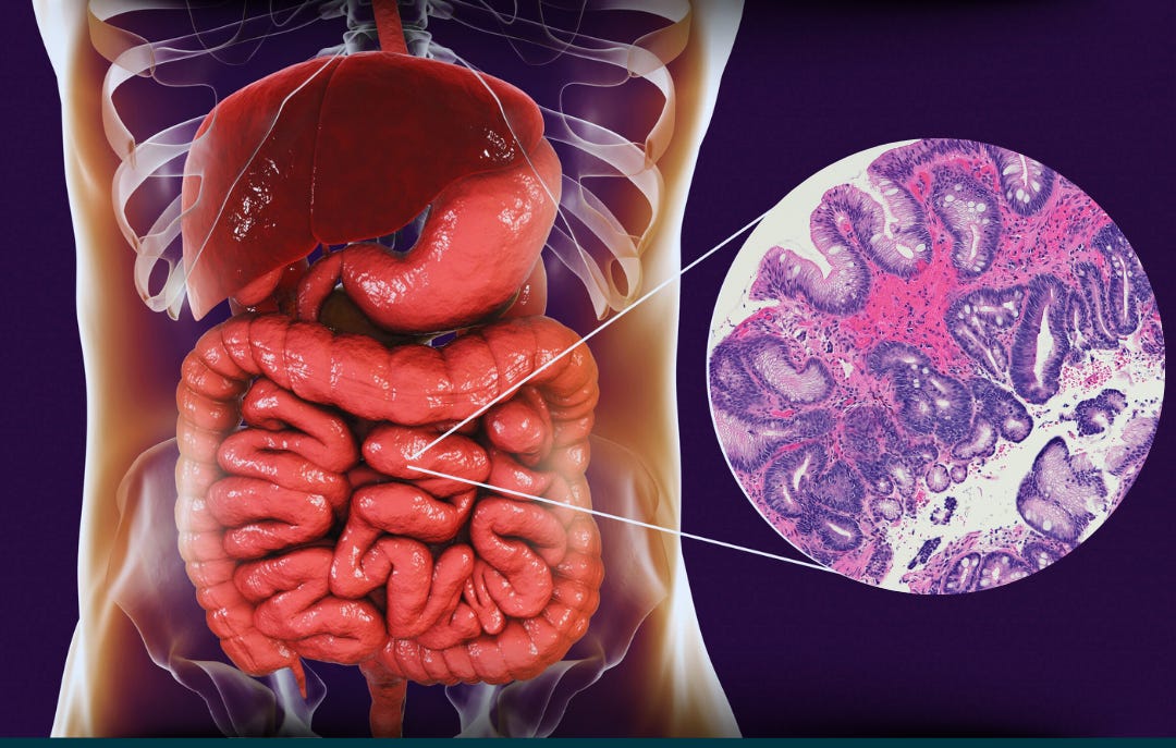 Metaplasia intestinal: o que é, sintomas, causas e tratamento