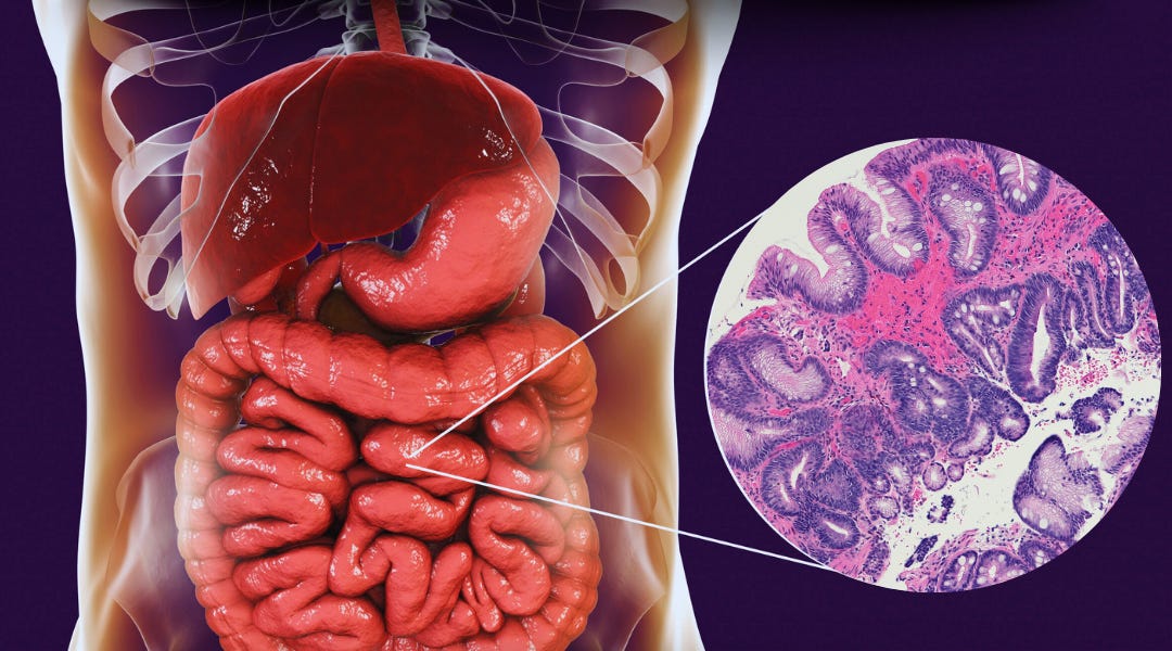 Metaplasia intestinal: o que é, sintomas, causas e tratamento