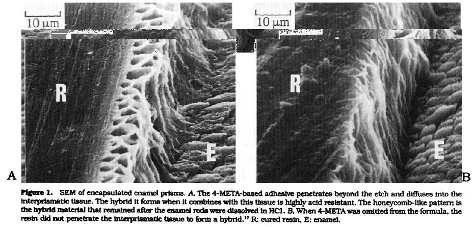 Hybrid Layer as a Dentin‑Bonding Mechanism - by Alex Besmer