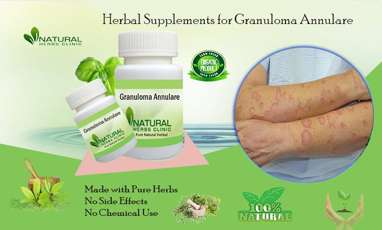 The Best Remedies for Granuloma Annulare: A Patient’s Guide to Healing