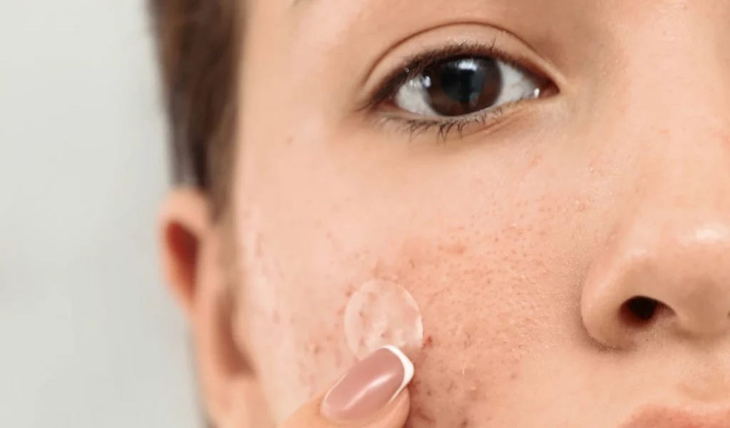 World Of Dentistry Explains Can Toothpaste On Pimples Overnight Treat Acne?