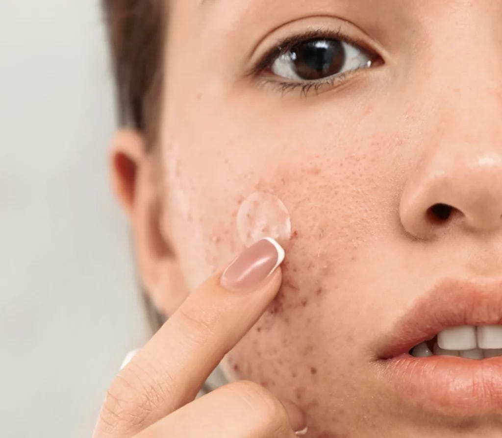 World Of Dentistry Explains Can Toothpaste On Pimples Overnight Treat Acne?