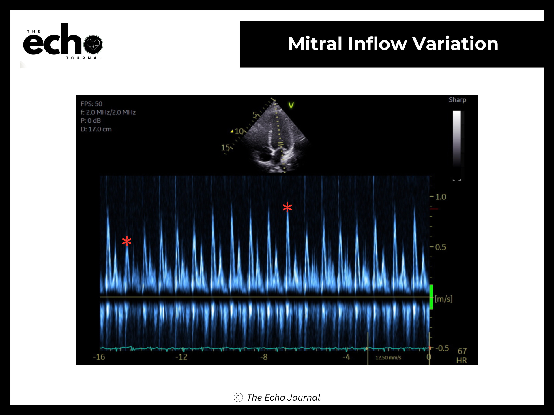 Constrictive Pericarditis: The Echo Findings You Can't Afford to Miss