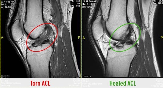 Beyond ACL Reconstruction - by Mick Hughes - The ACL Hub