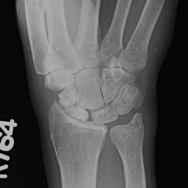 Scaphoid fracture and scapholunate dissocation