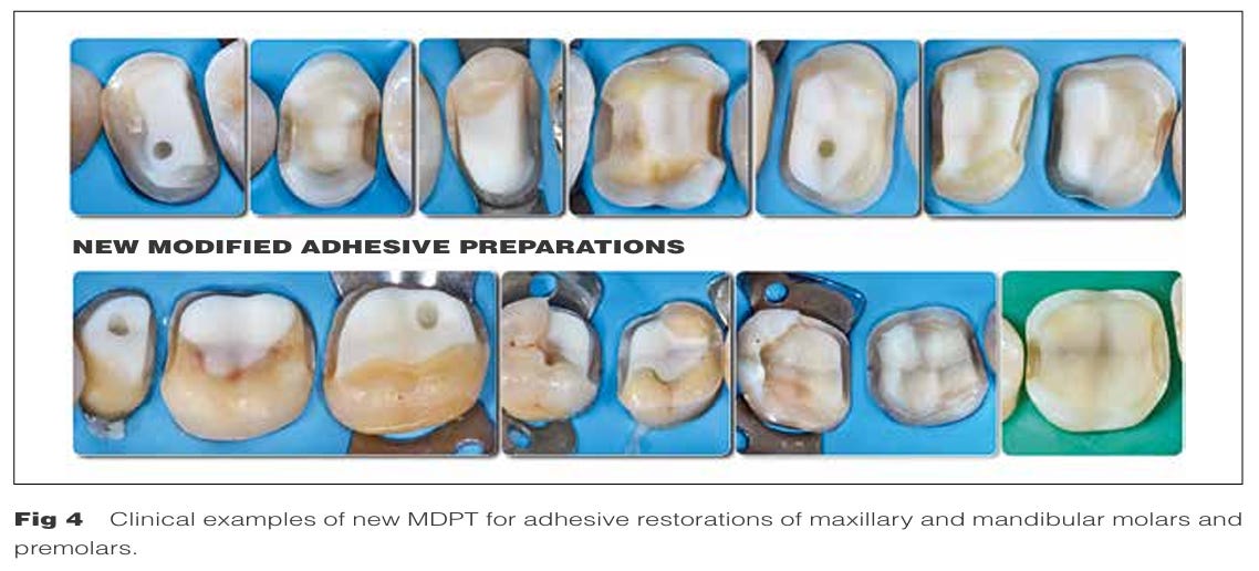 Posterior indirect adhesive restorations: updated indications and the ...
