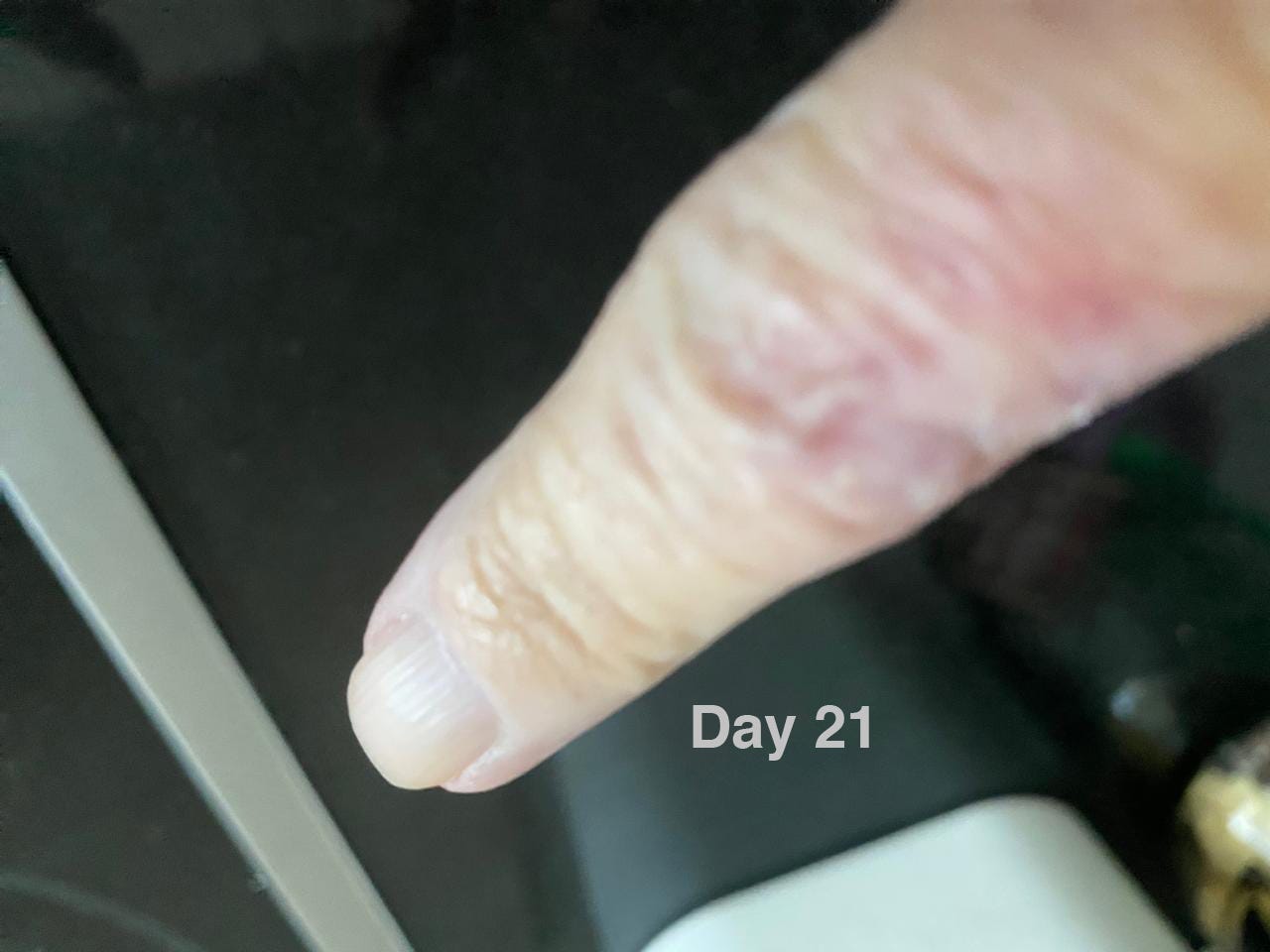 Case Report: Squamous Cell Carcinoma, age 80, Female
