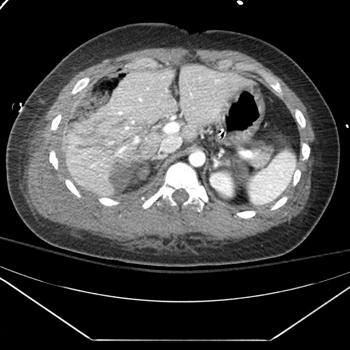 Spinal distraction injuries and dislocation