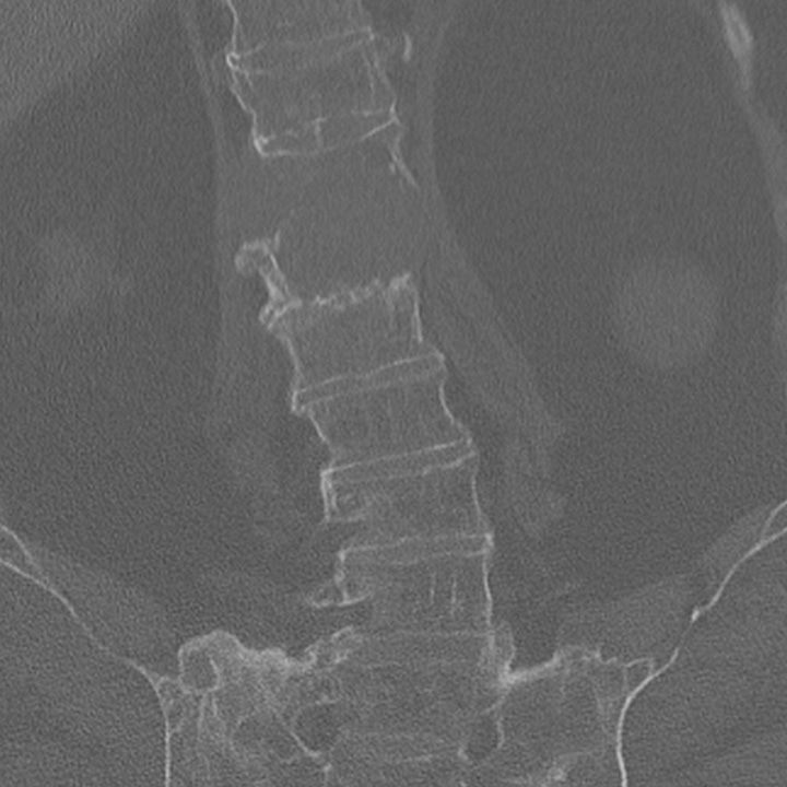 Spinal distraction injuries and dislocation