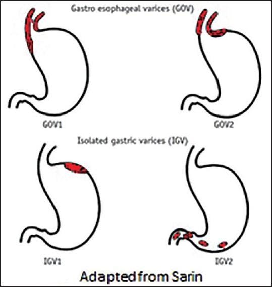 Endoscopic Therapy for Bleeding Gastroesophageal Varix (GOV 2)