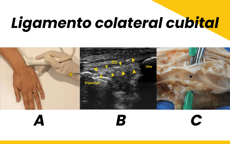 Ligamento colateral radial y ligamento colateral cubital