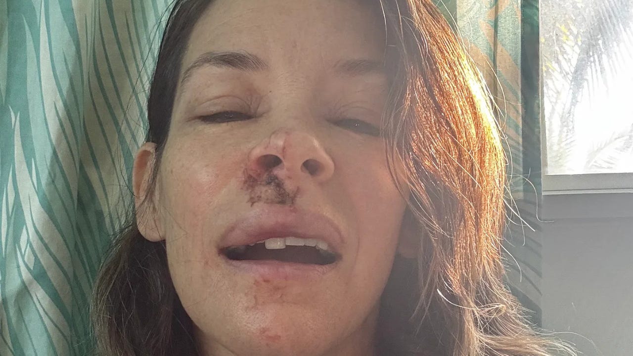 Evangeline Lilly Reveals She Is Suffering "Brain Damage" After Fainting ...