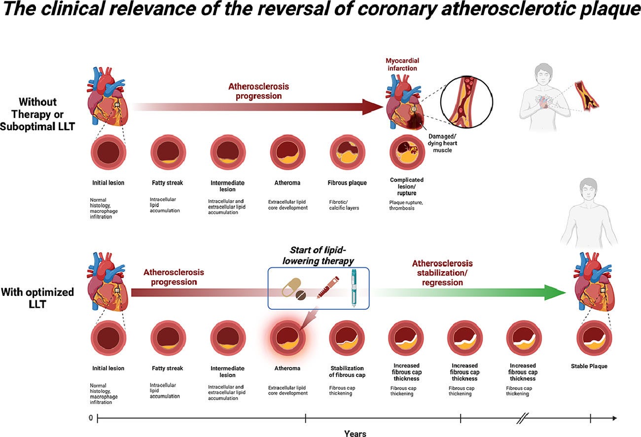 Understanding Atherosclerotic Cardiovascular Disease (ASCVD)
