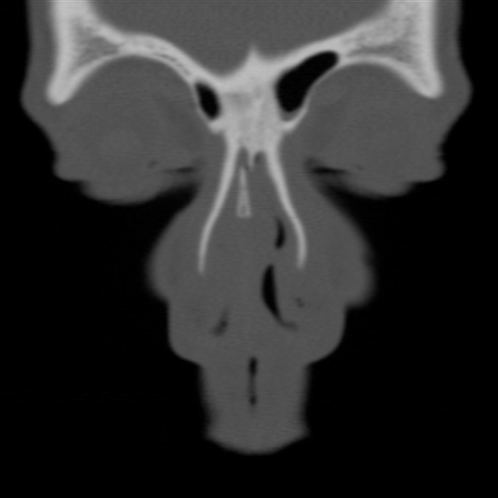 Nasal and Naso-orbito-ethmoid Fractures