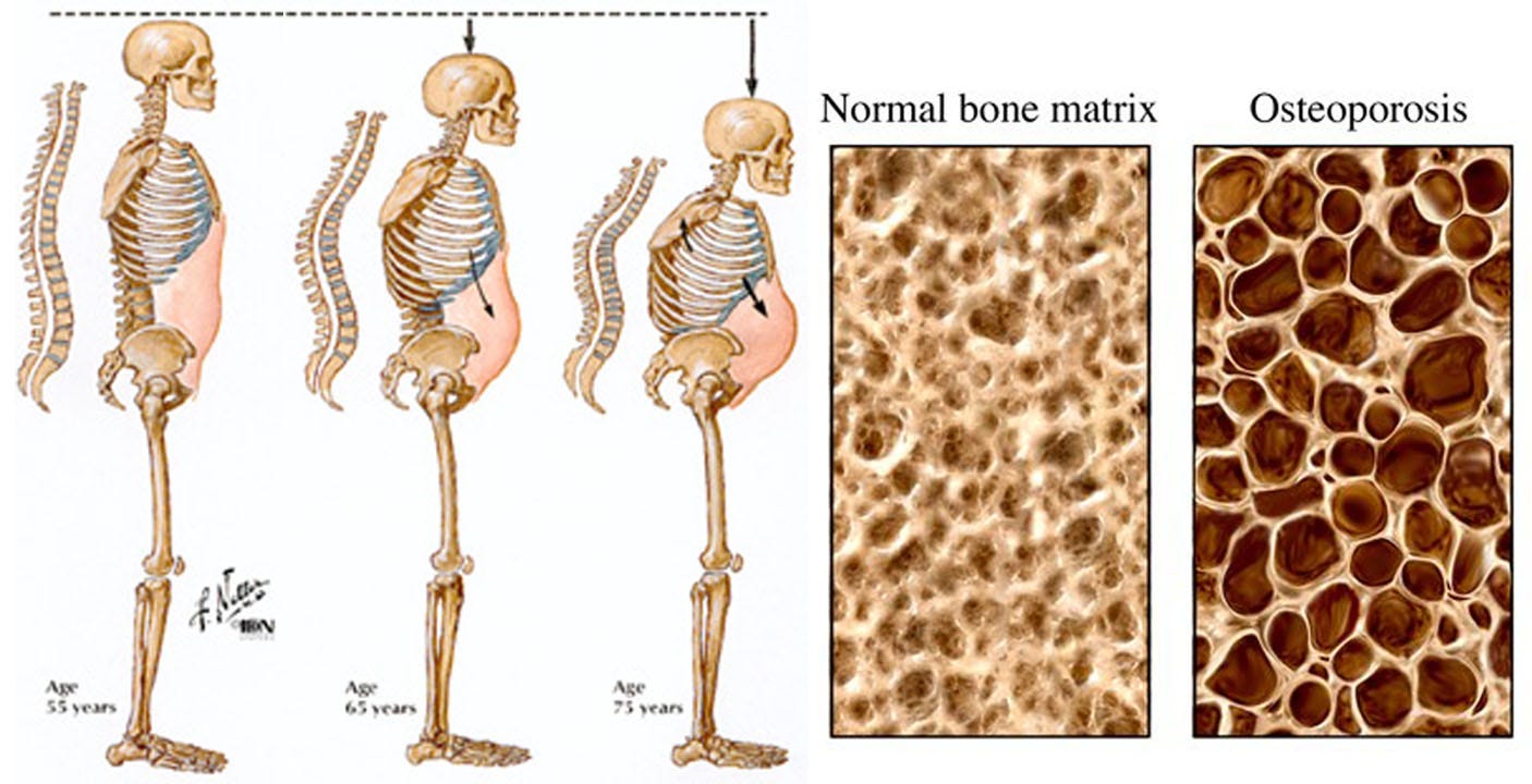Rethinking Osteoporosis: The Gut–Bone Axis, Immune Balance, and Herbal ...