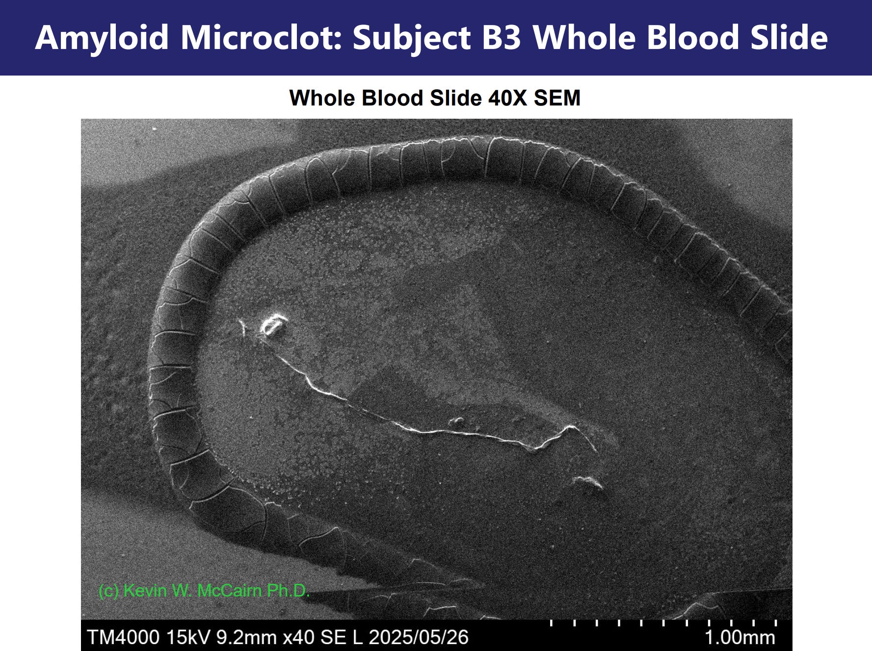 Fibrous Clots Found In Young Child Born To Pfizer-Vaccinated Pregnant ...