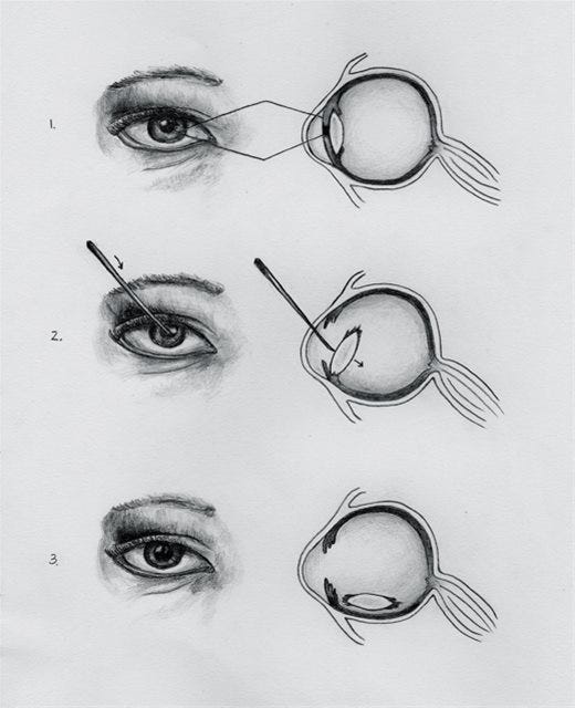 Through Roman Eyes: Translating Celsus on Ancient Ophthalmology