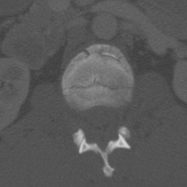 Spinal distraction injuries and dislocation