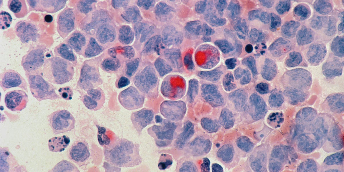 The Link Between Lupus and Cancer