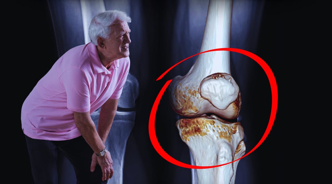 Artrose tem cura? O que fazer para tratar
