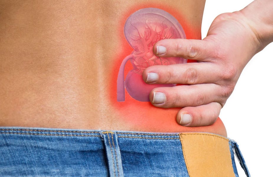 IBS & kidney stones. Surprising link...