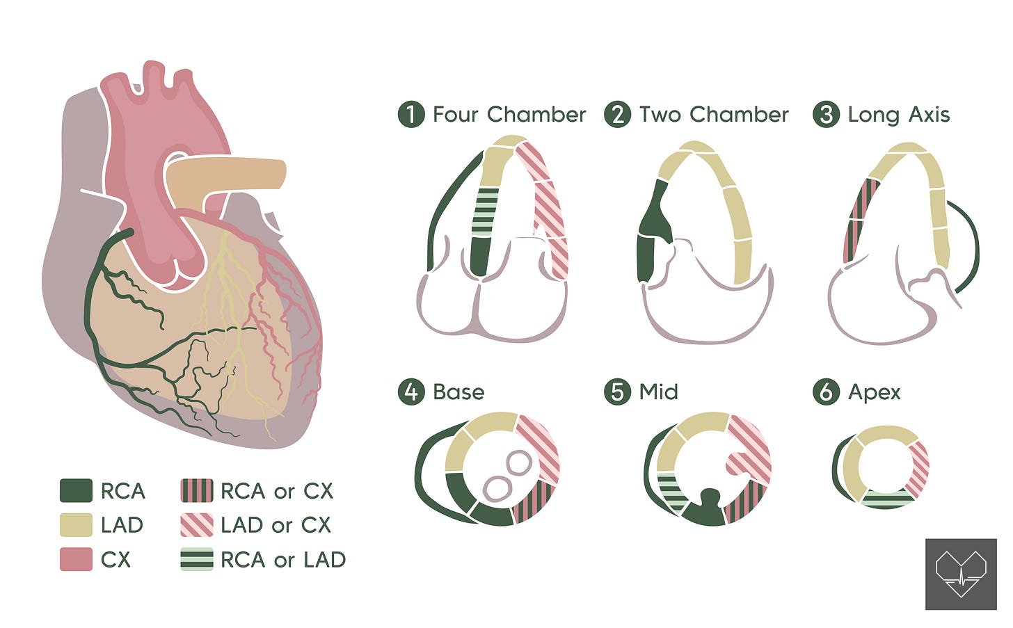 What is a Regional Wall Motion Abnormality?